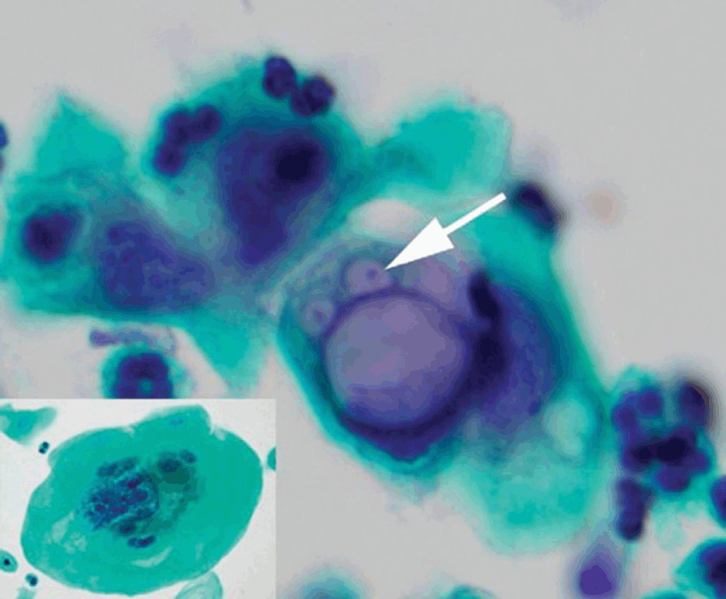 The Pap Smear (Chapter 1) - Differential Diagnosis in Cytopathology