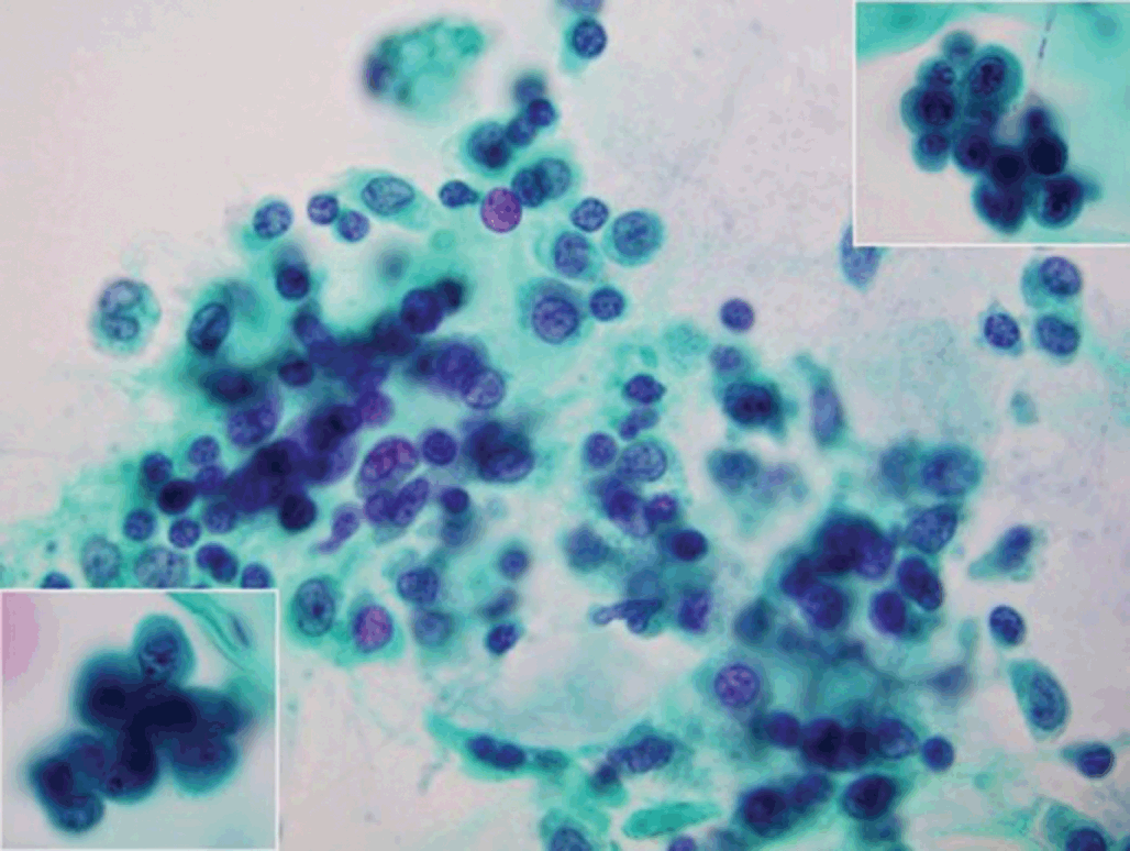 The Pap Smear (Chapter 1) - Differential Diagnosis in Cytopathology