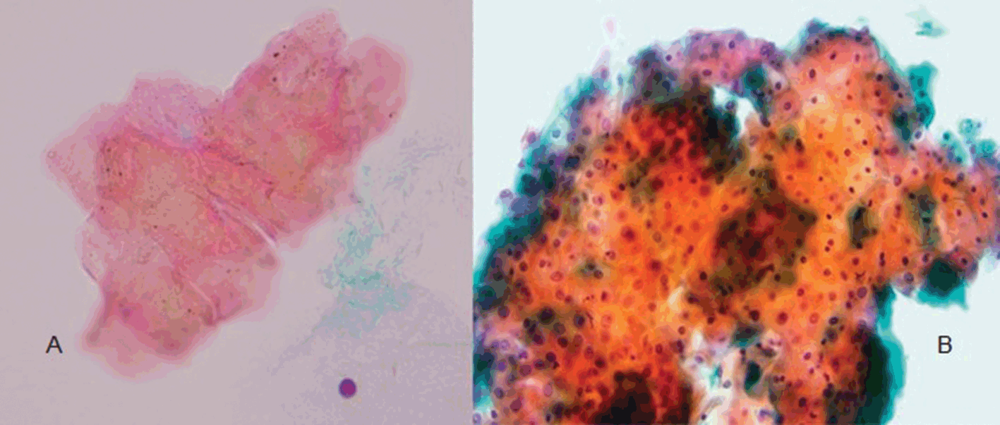 The Pap Smear (Chapter 1) - Differential Diagnosis in Cytopathology