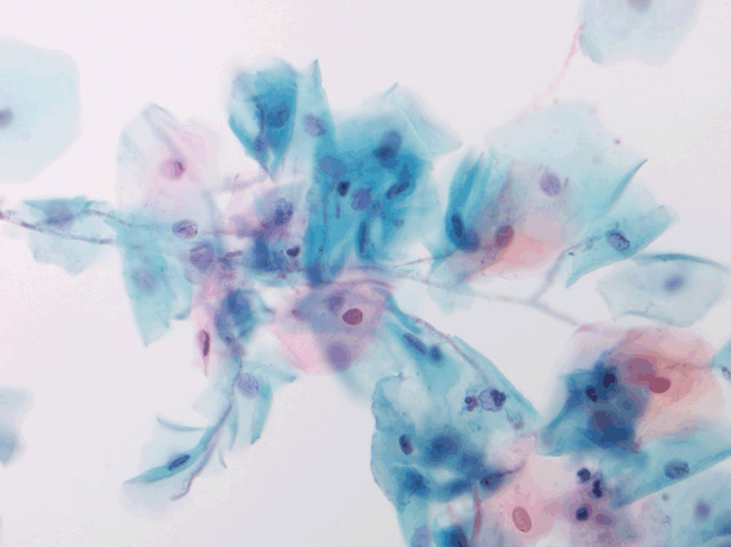 The Pap Smear (Chapter 1) - Differential Diagnosis in Cytopathology