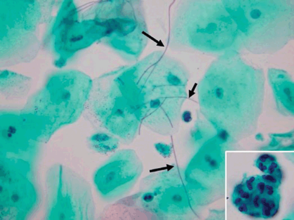 The Pap Smear (Chapter 1) - Differential Diagnosis in Cytopathology