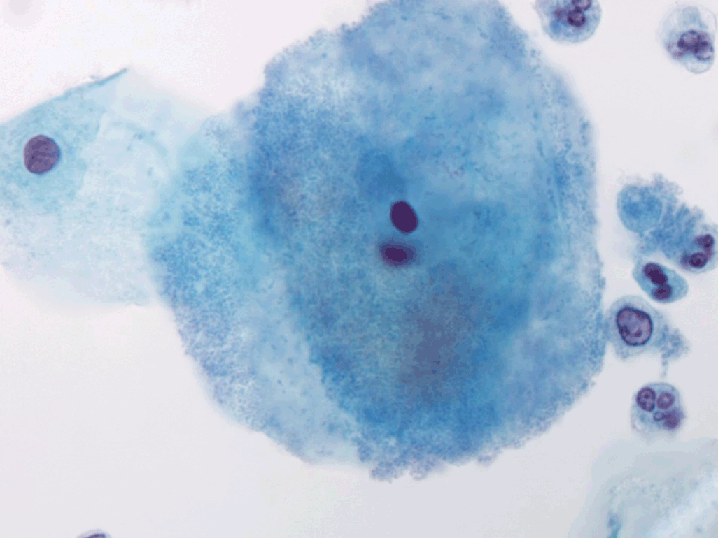 The Pap Smear (Chapter 1) - Differential Diagnosis in Cytopathology
