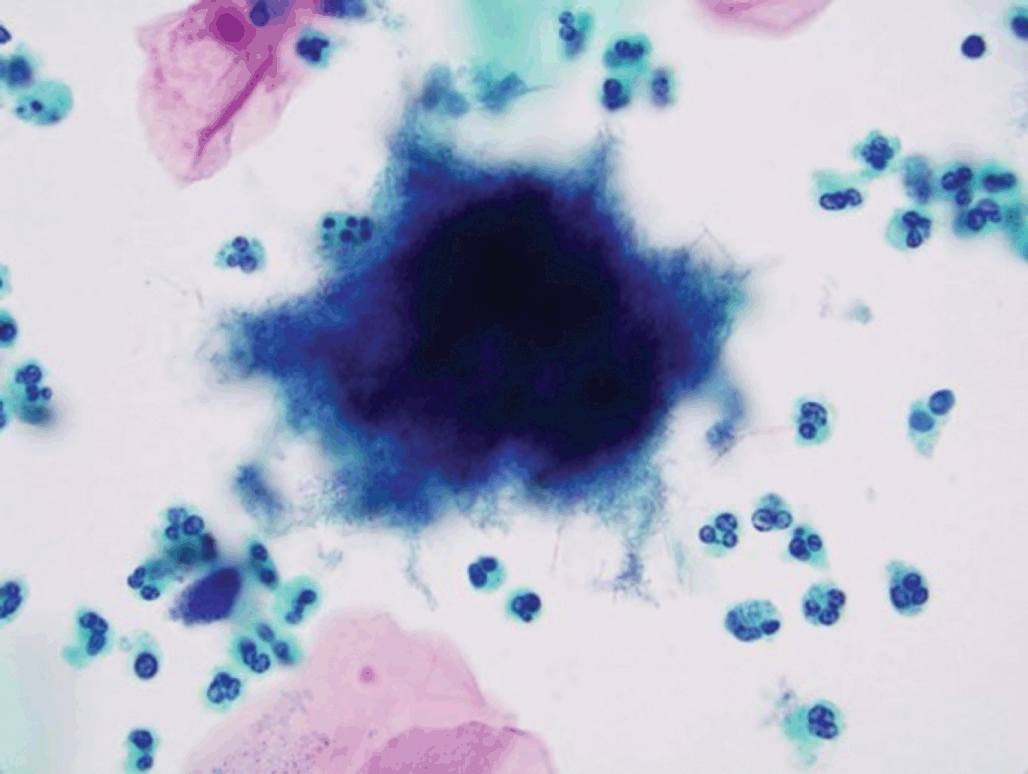 The Pap Smear (Chapter 1) - Differential Diagnosis in Cytopathology