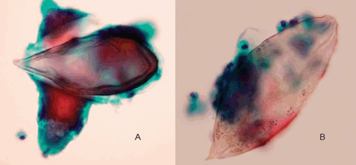The Pap Smear (Chapter 1) - Differential Diagnosis in Cytopathology