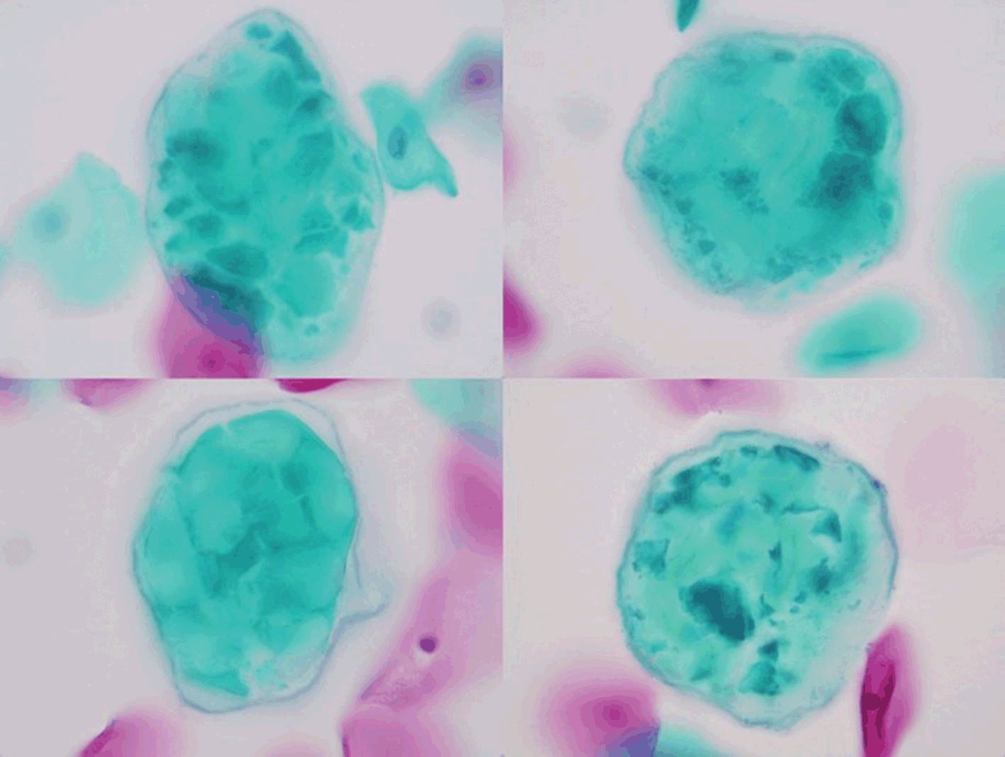 The Pap Smear (Chapter 1) - Differential Diagnosis in Cytopathology