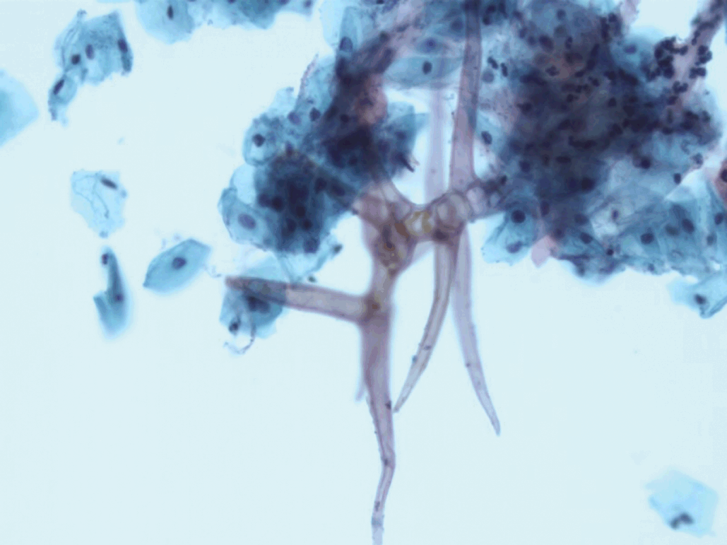 The Pap Smear (Chapter 1) - Differential Diagnosis in Cytopathology