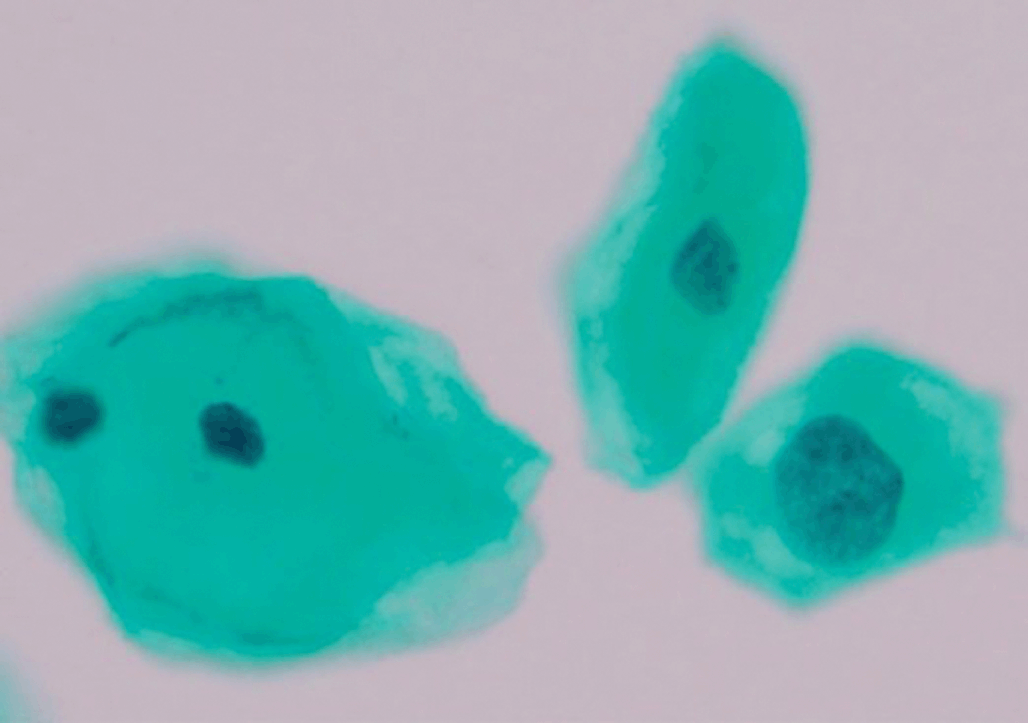 The Pap Smear (Chapter 1) - Differential Diagnosis in Cytopathology