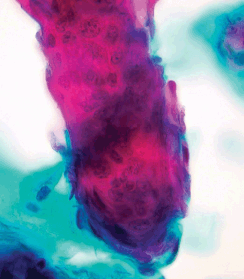 The Pap Smear (Chapter 1) - Differential Diagnosis in Cytopathology