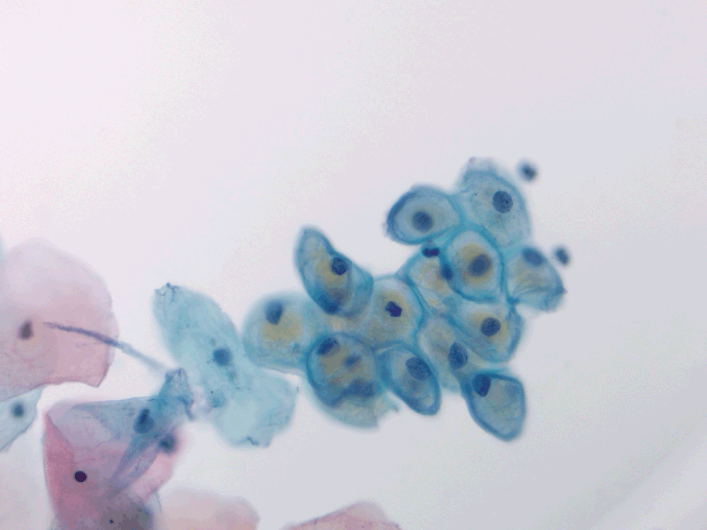 The Pap Smear (Chapter 1) - Differential Diagnosis in Cytopathology