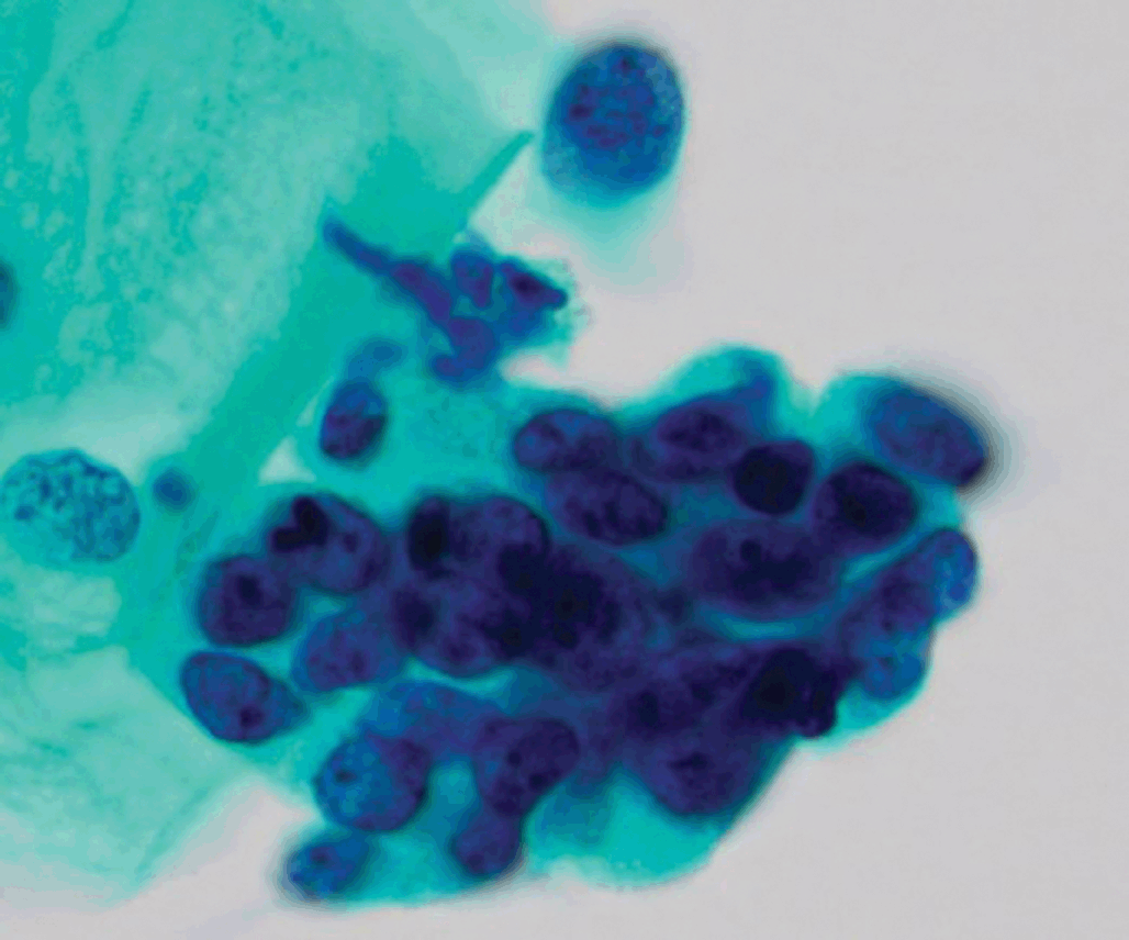 The Pap Smear (Chapter 1) - Differential Diagnosis in Cytopathology