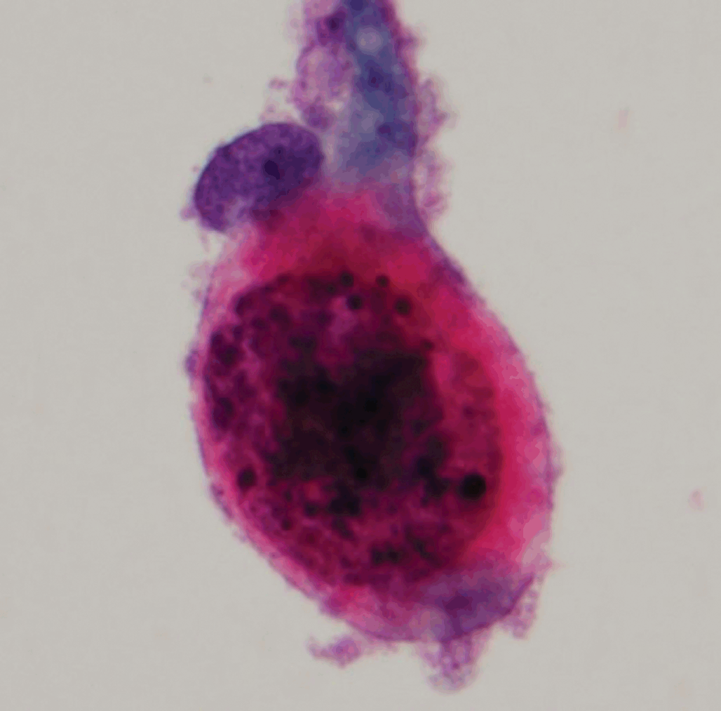 The Pap Smear (Chapter 1) - Differential Diagnosis in Cytopathology