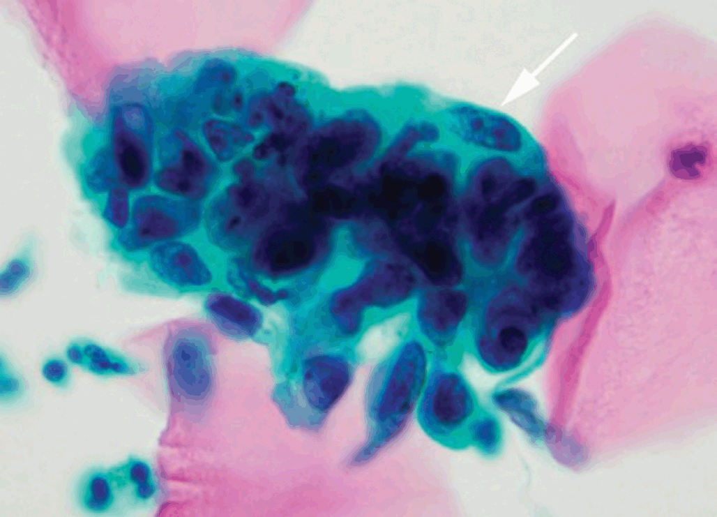 The Pap Smear (Chapter 1) - Differential Diagnosis in Cytopathology