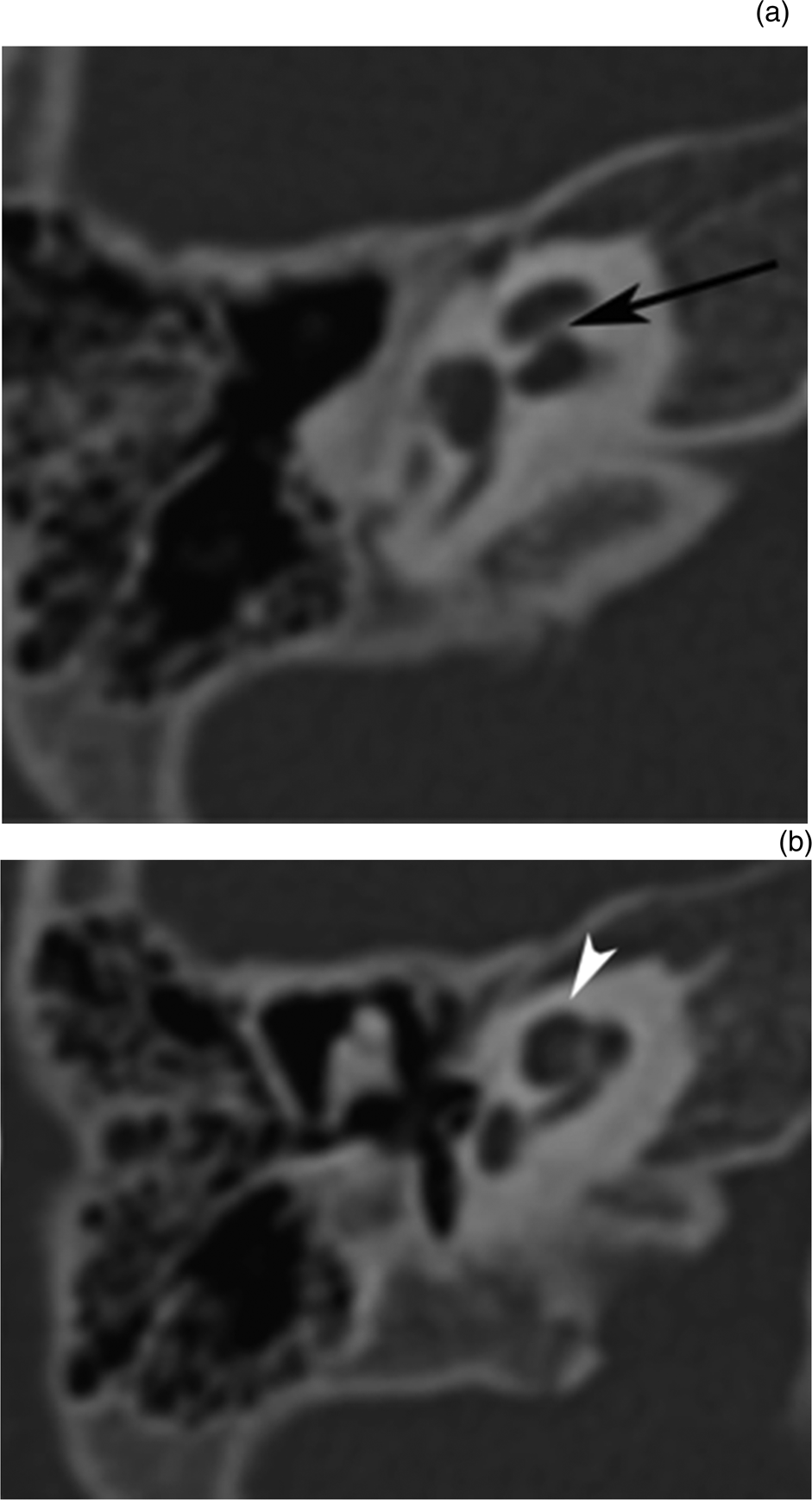 Cochlear nerve canal stenosis and associated semicircular canal ...