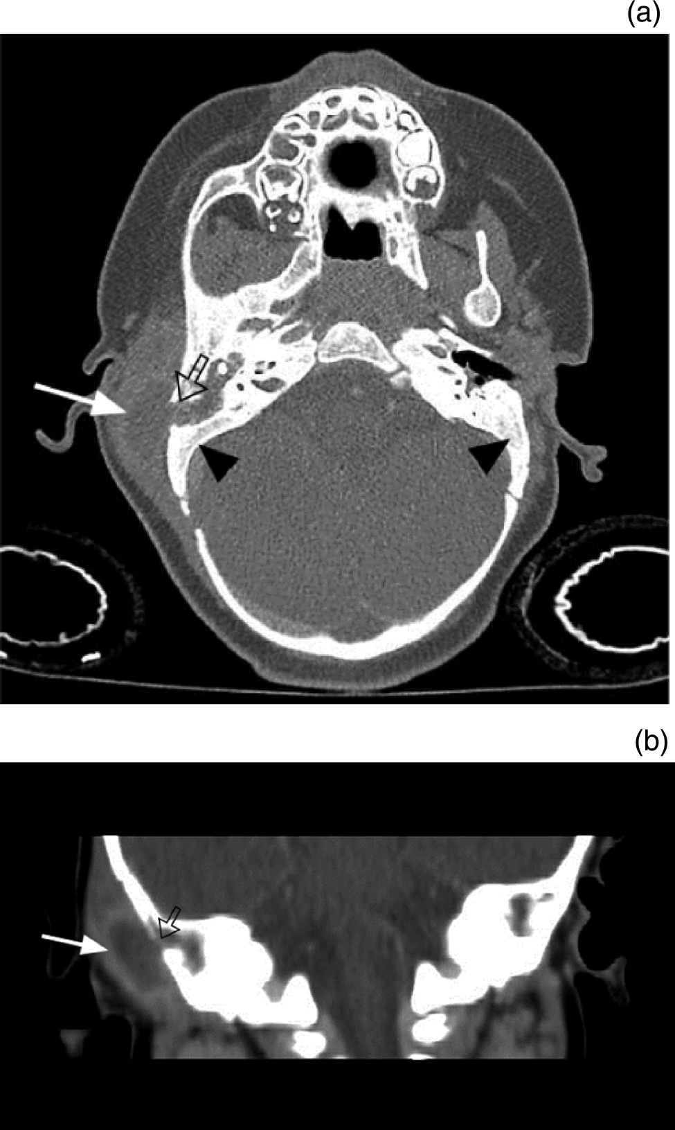 Acute mastoiditis in infants aged six months or younger | The Journal ...