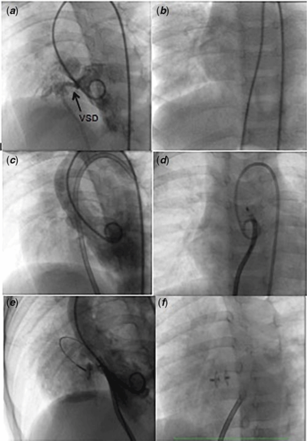 Procedural and short-term outcomes of transcatheter closure of ...