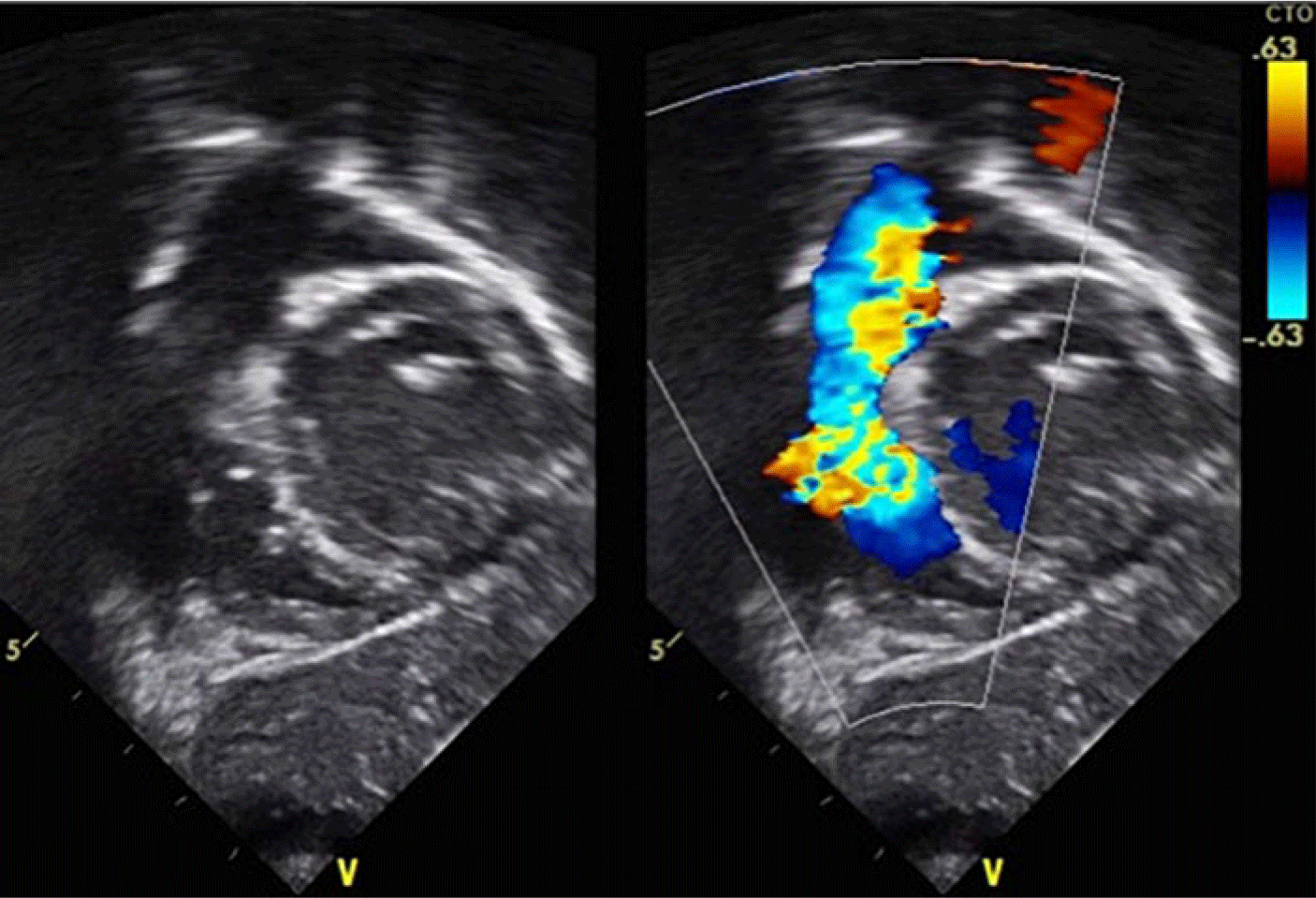 Procedural and short-term outcomes of transcatheter closure of ...