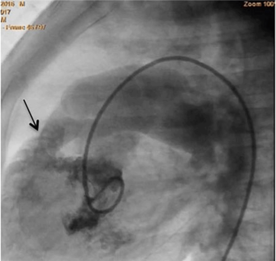 Procedural and short-term outcomes of transcatheter closure of ...