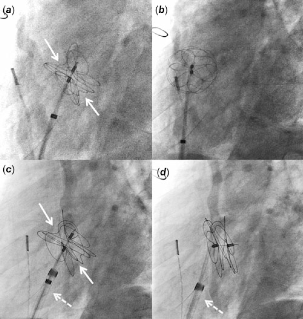 Use of Mullins sheath to prevent prolapse of Gore Cardioform ASD ...