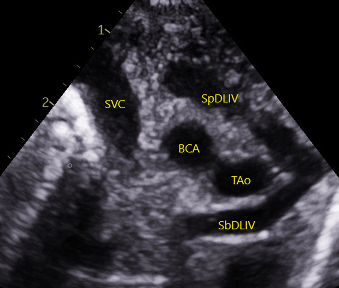 Circumaortic double left innominate vein: a rare echocardiographic ...