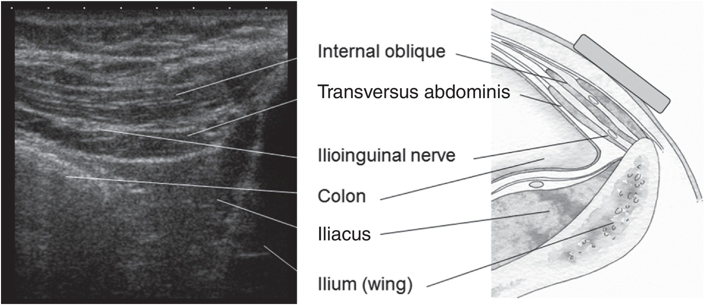 Ilioinguinal Nerve Block Ultrasound