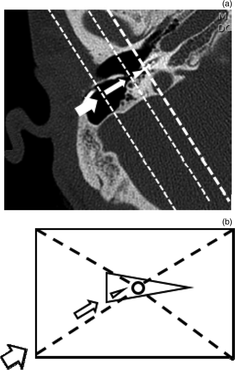 Surgical considerations during cochlear implantation: the utility of ...