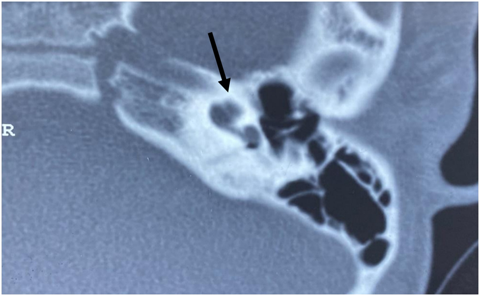 Cochlear implantation in children with Mondini dysplasia: our ...