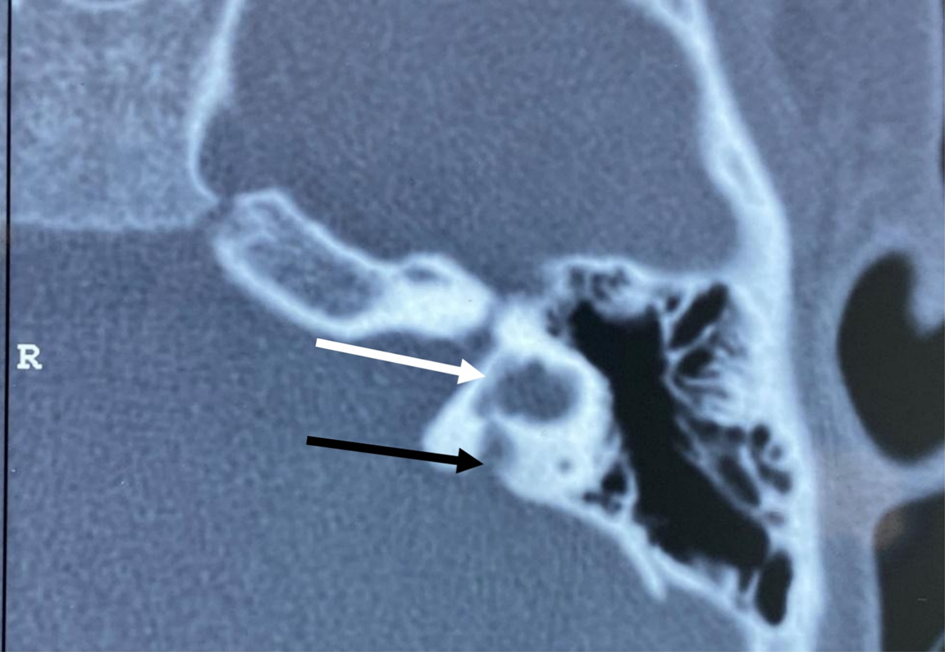 Cochlear implantation in children with Mondini dysplasia: our ...