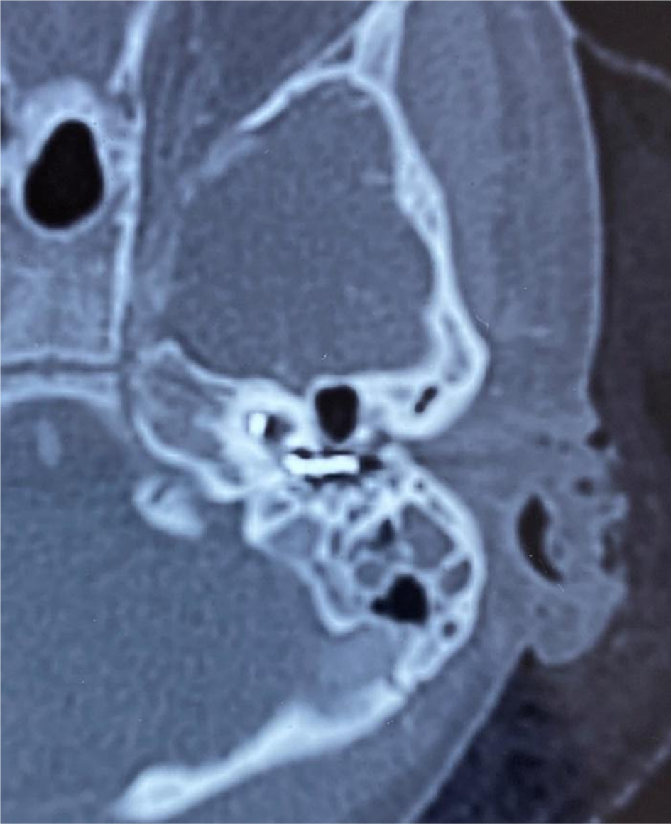 Cochlear implantation in children with Mondini dysplasia: our ...