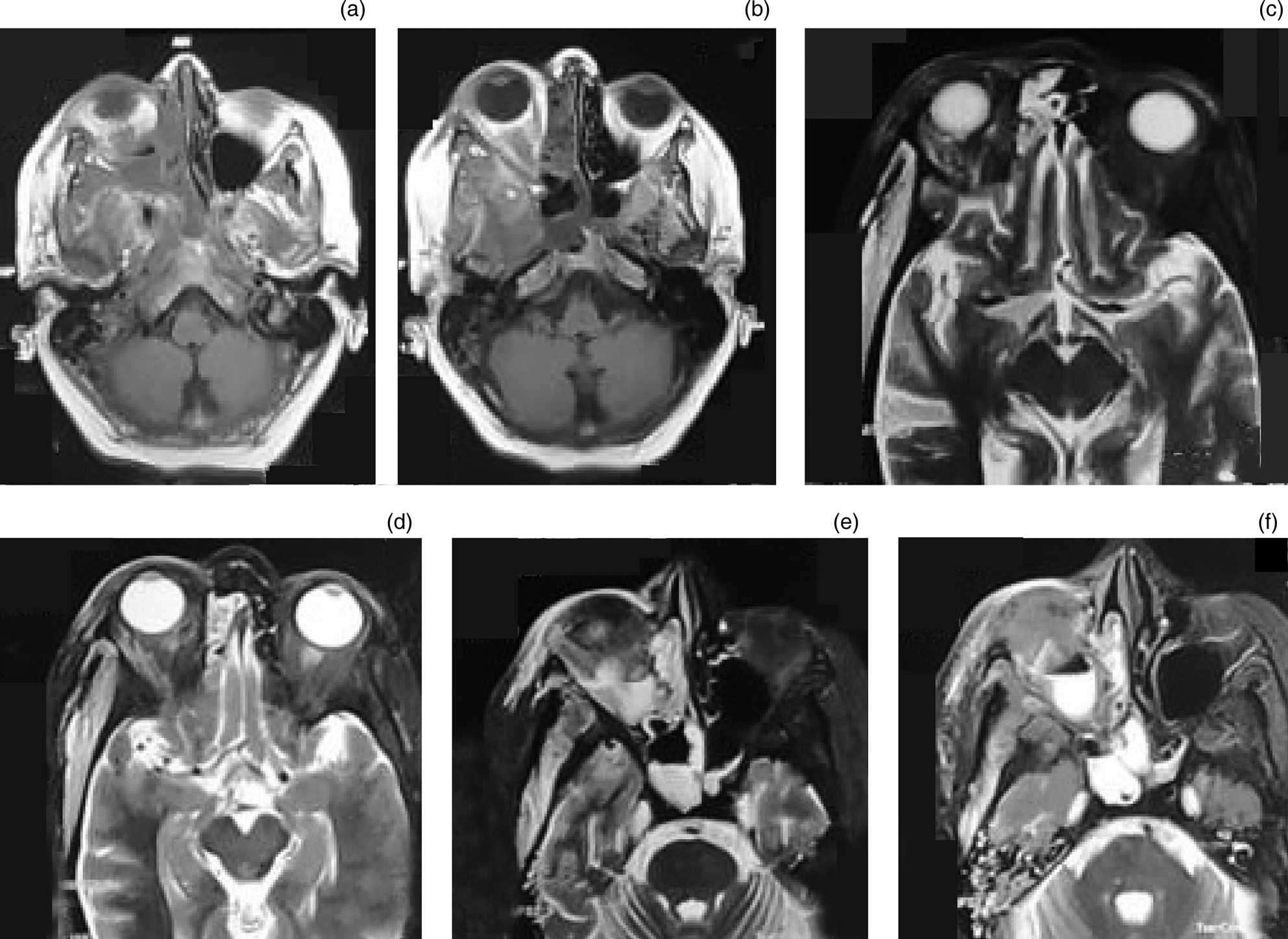 Post coronavirus disease mucormycosis: a deadly addition to the ...