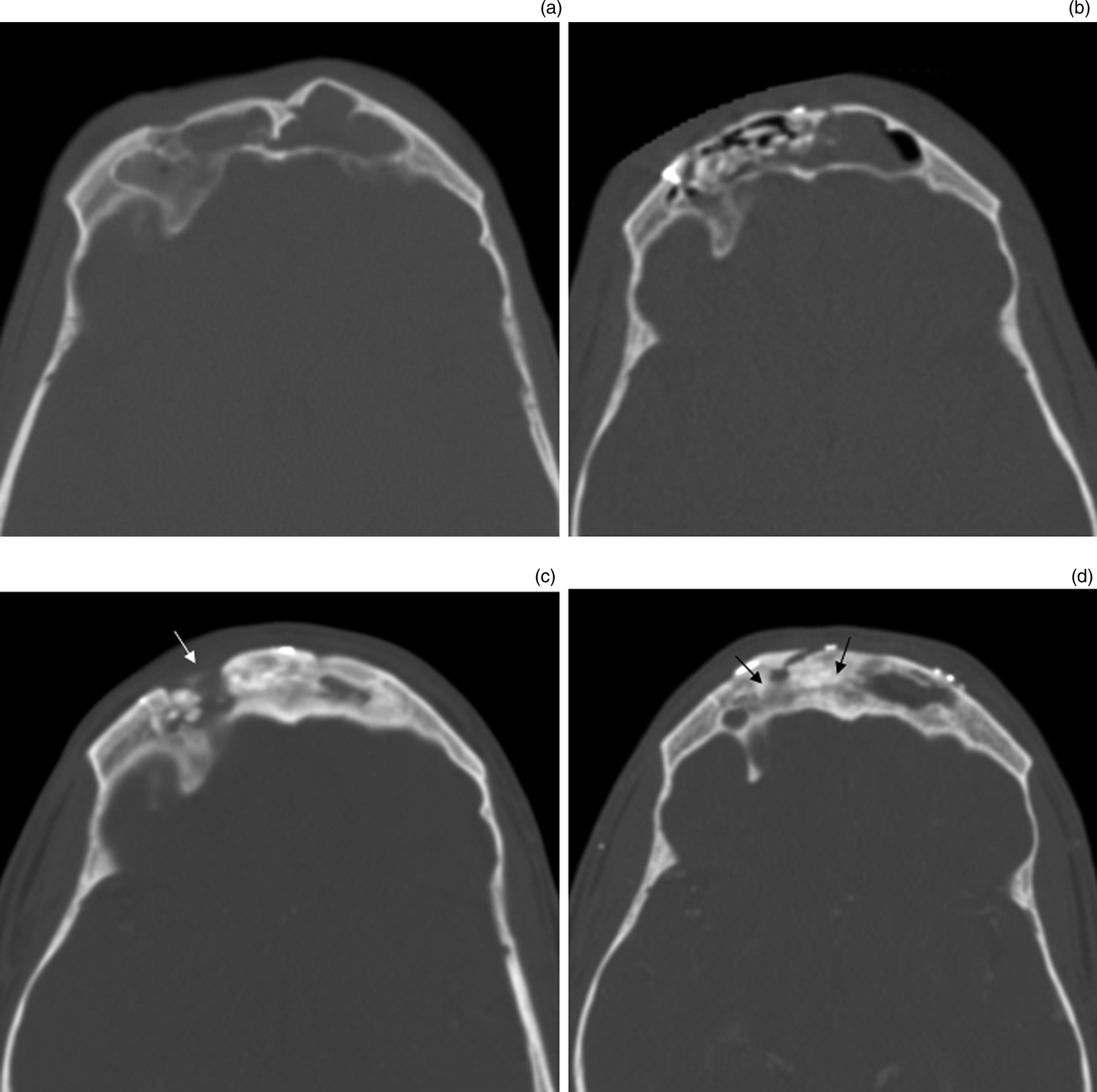 Repair of frontal sinus fractures: clinical and radiological long-term ...