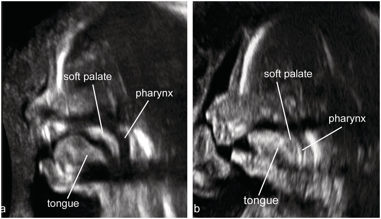 Cleft Palate Ultrasound Fetal