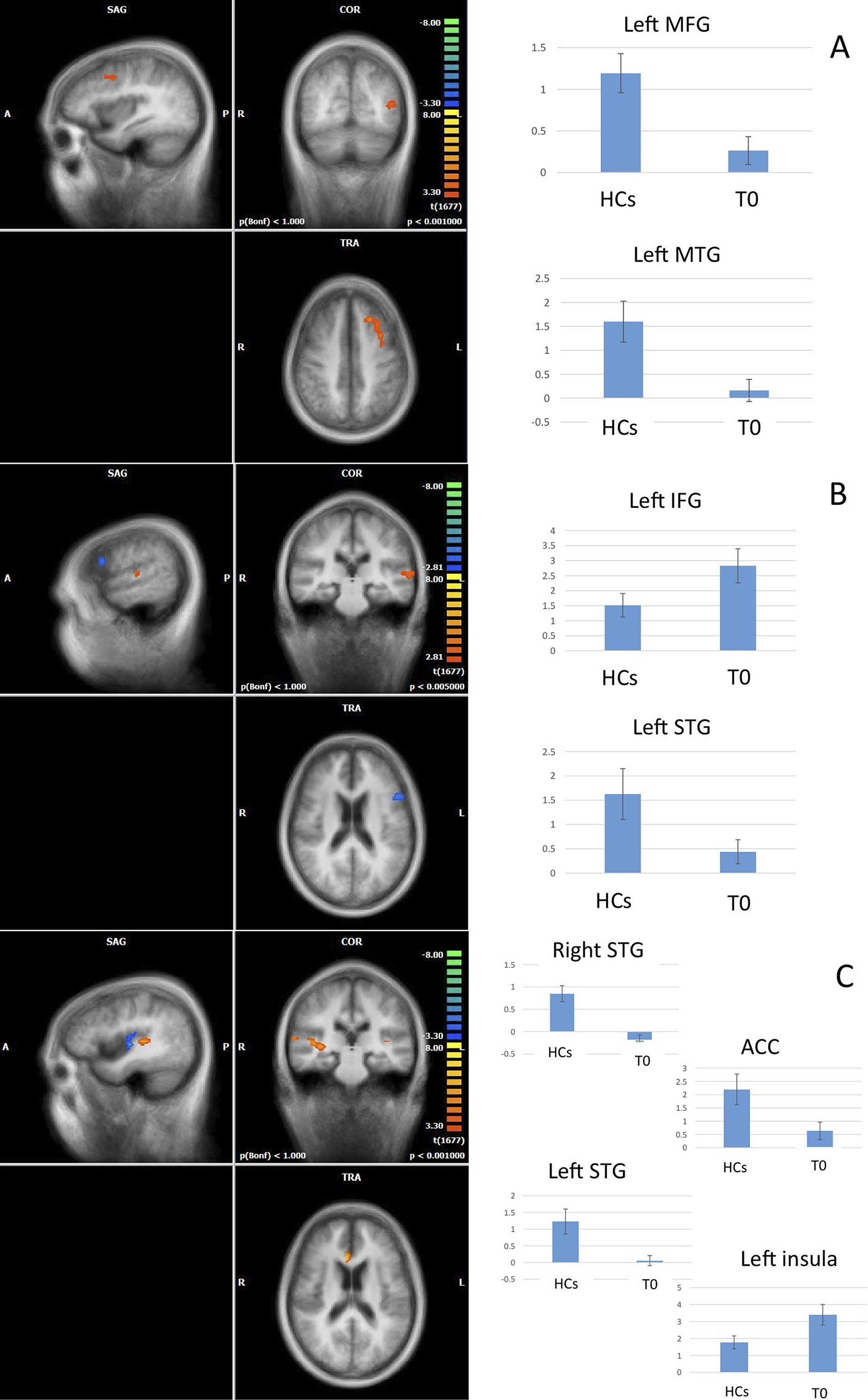 Frontotemporal degeneration in amyotrophic lateral sclerosis (ALS): a ...