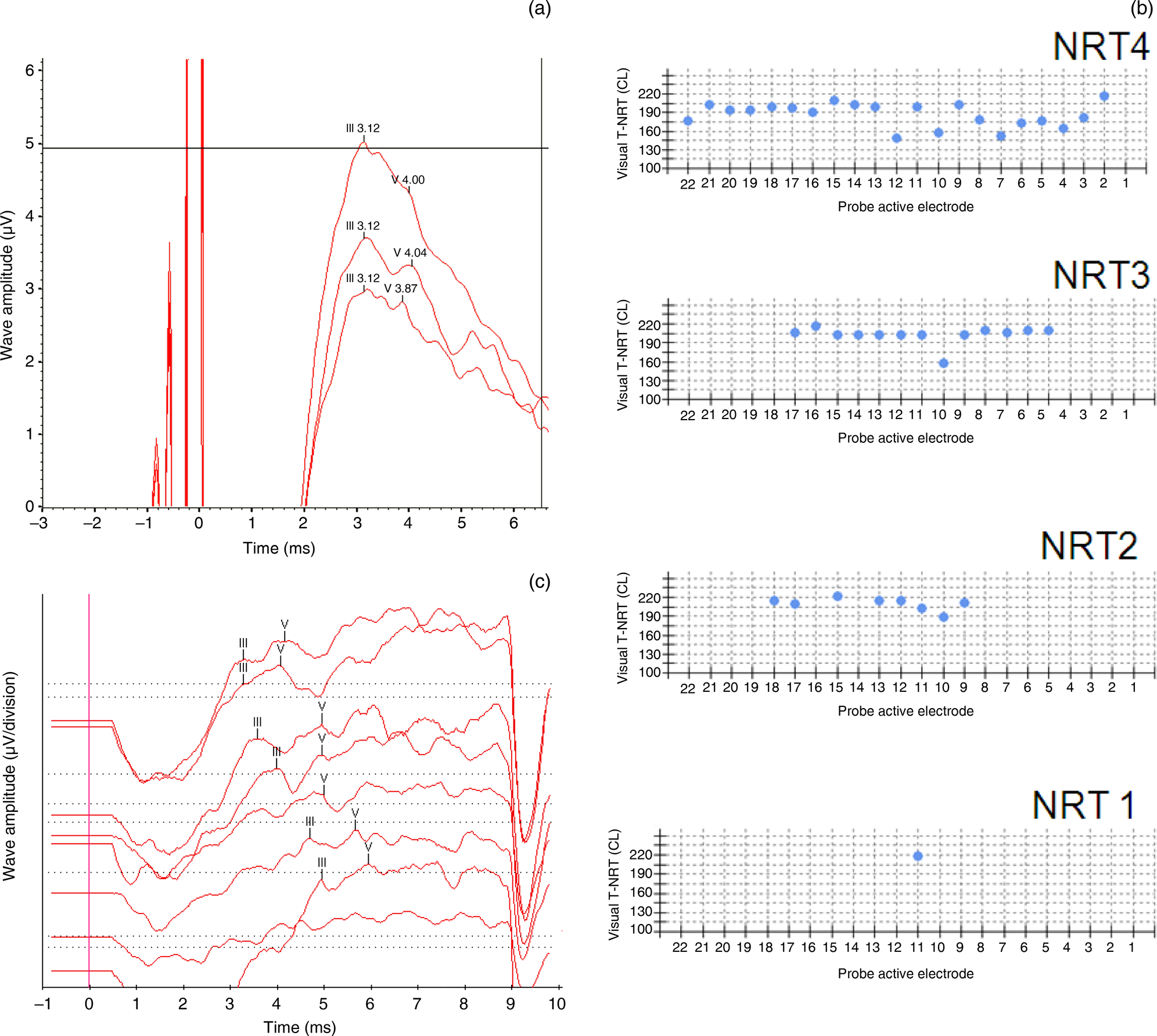 Cochlear implantation in auditory neuropathy spectrum disorders: role ...