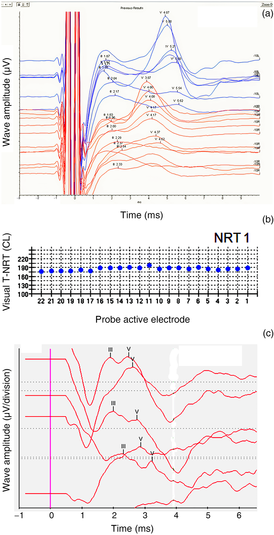 Cochlear implantation in auditory neuropathy spectrum disorders: role ...