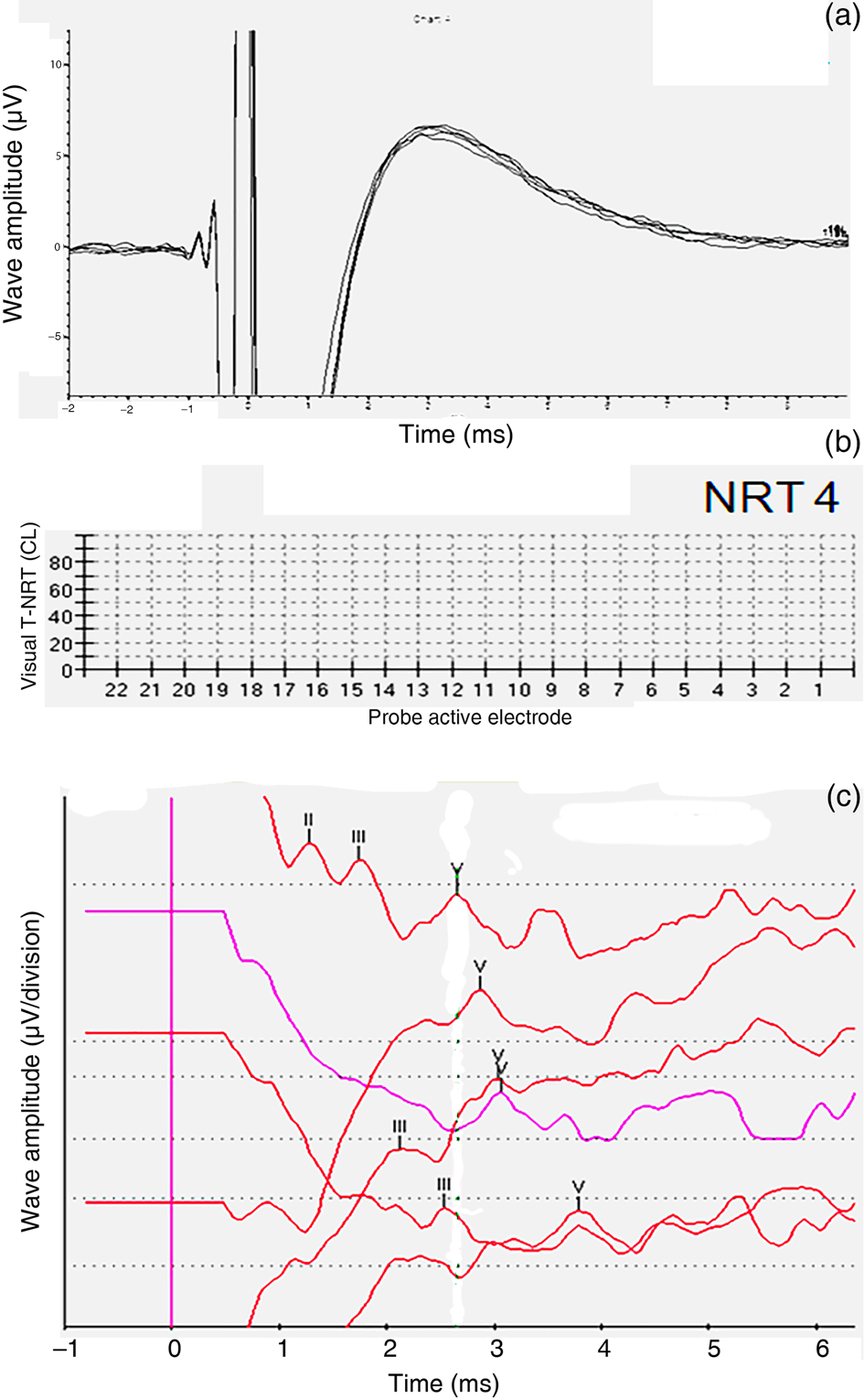 Cochlear implantation in auditory neuropathy spectrum disorders: role ...