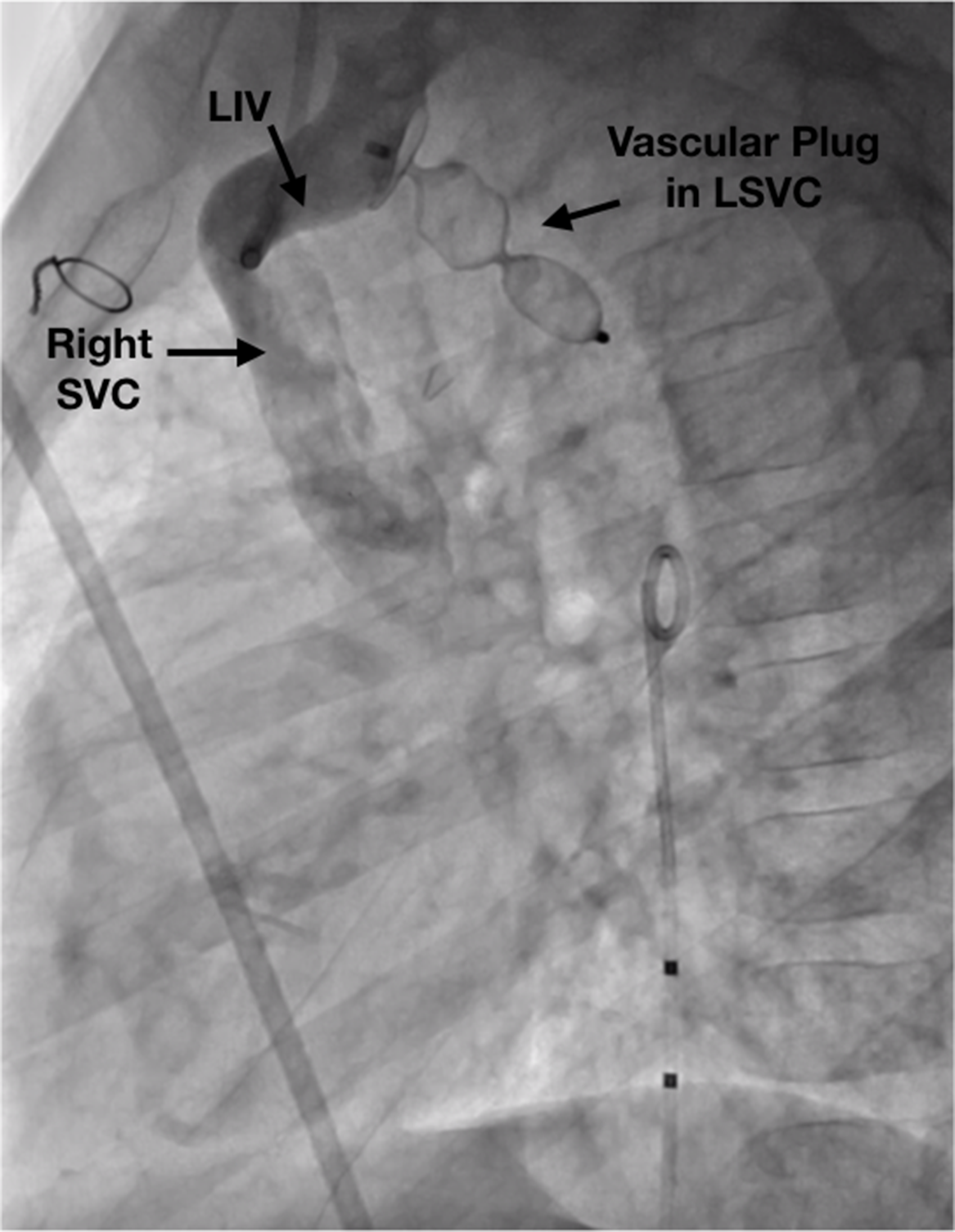 Coronary sinus ostial atresia with persistent left superior vena cava ...