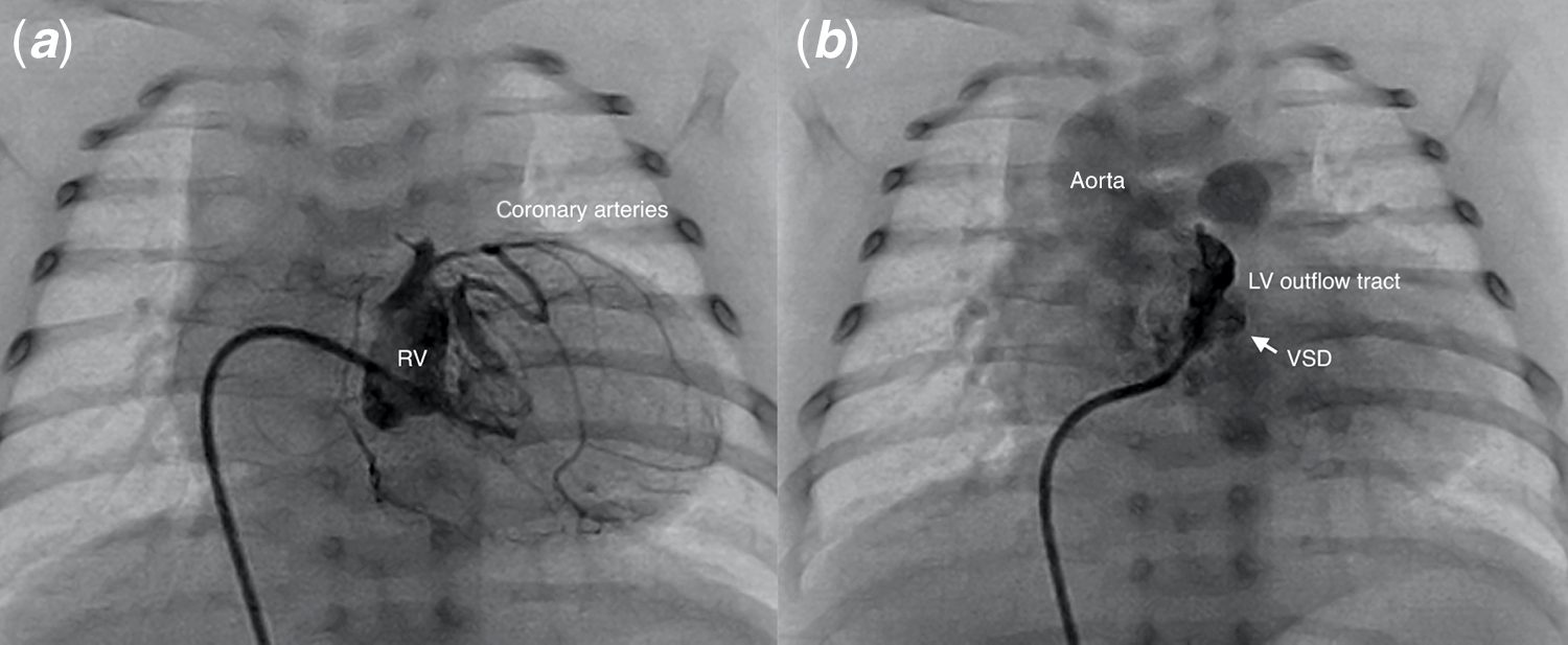 Bilateral coronary ostial atresia in a patient with pulmonary atresia ...