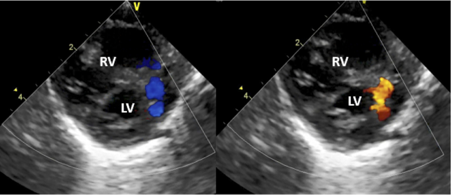 Congenital absence of coronary ostia in a single/common coronary system ...