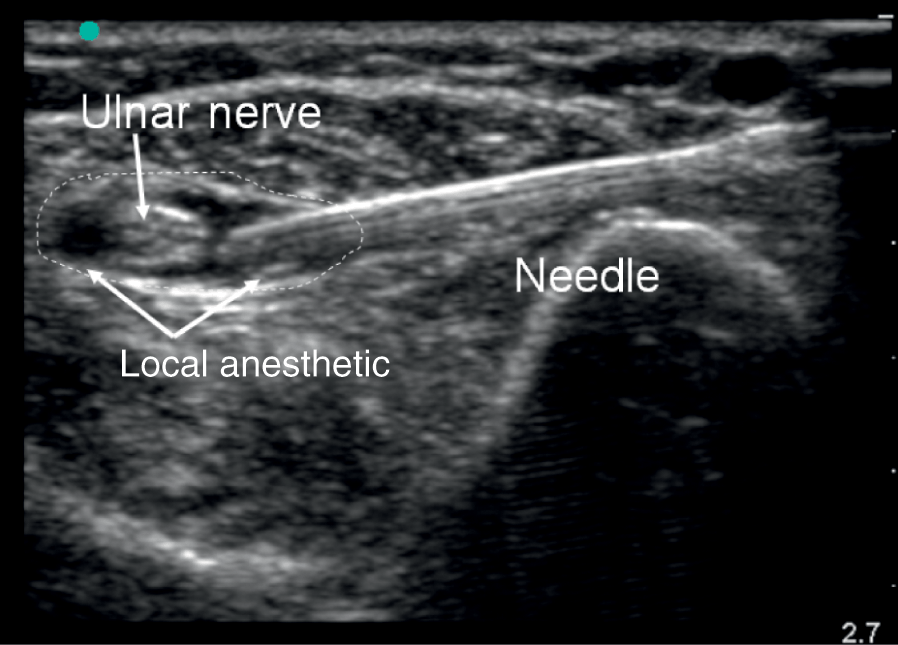 Genitofemoral Nerve Block Ultrasound
