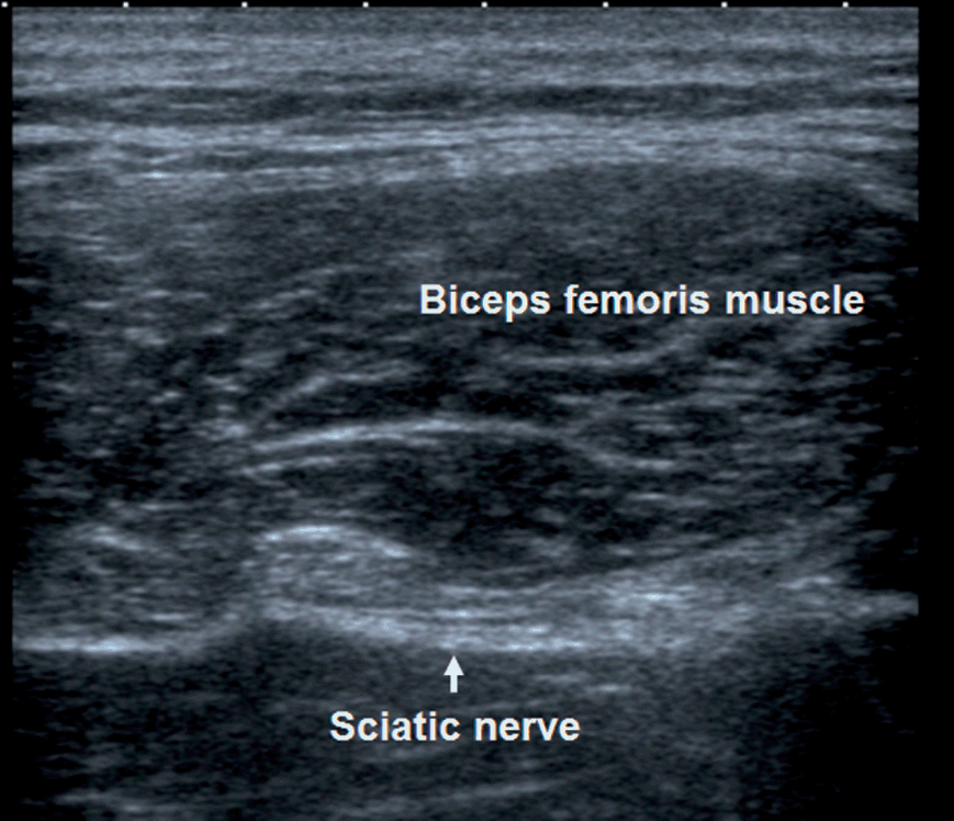 Obturator Internus Muscle Ultrasound