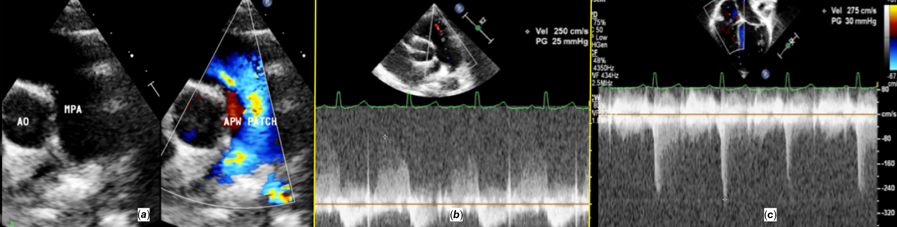 Surgical management of aortopulmonary window with pulmonary artery ...