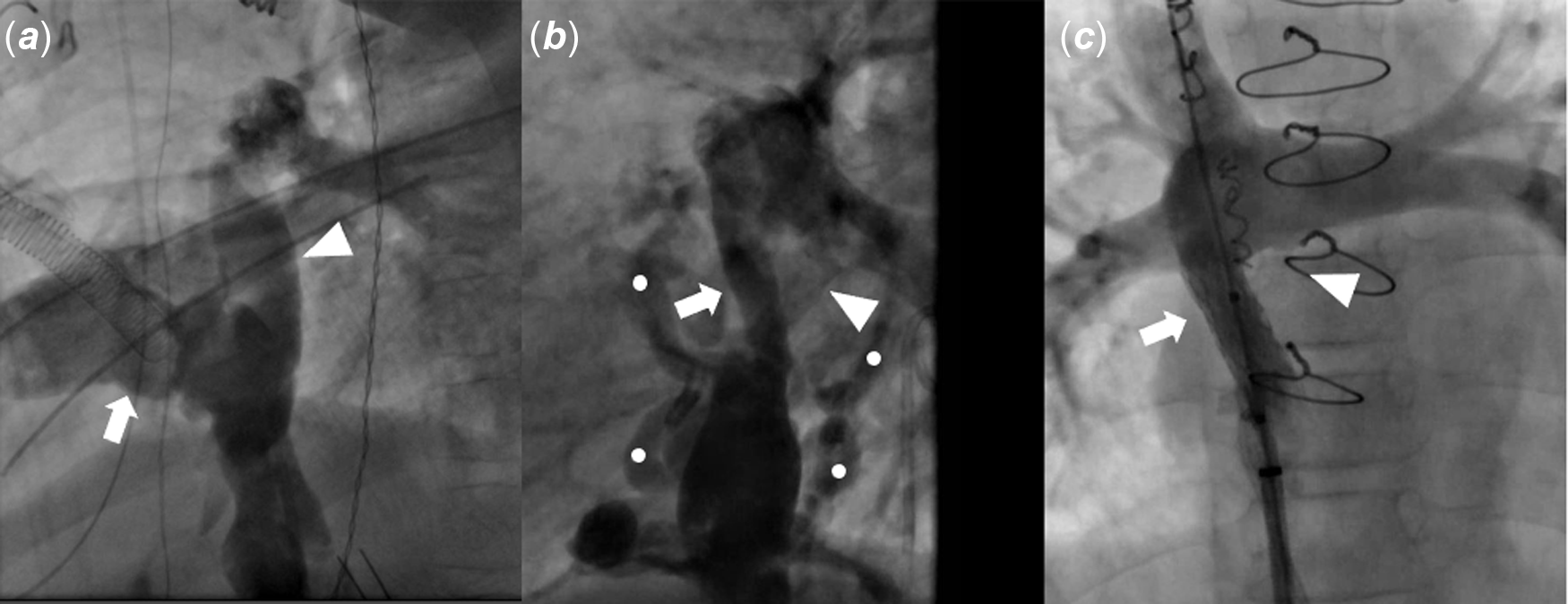 Severe conduit stenosis in a patient with Fontan circulation with a Y ...