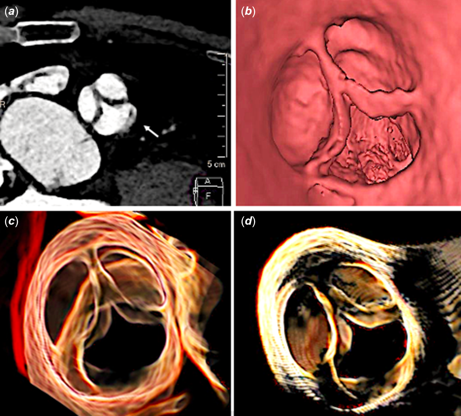 Single pulmonary valve cusp agenesis first detected by computed ...