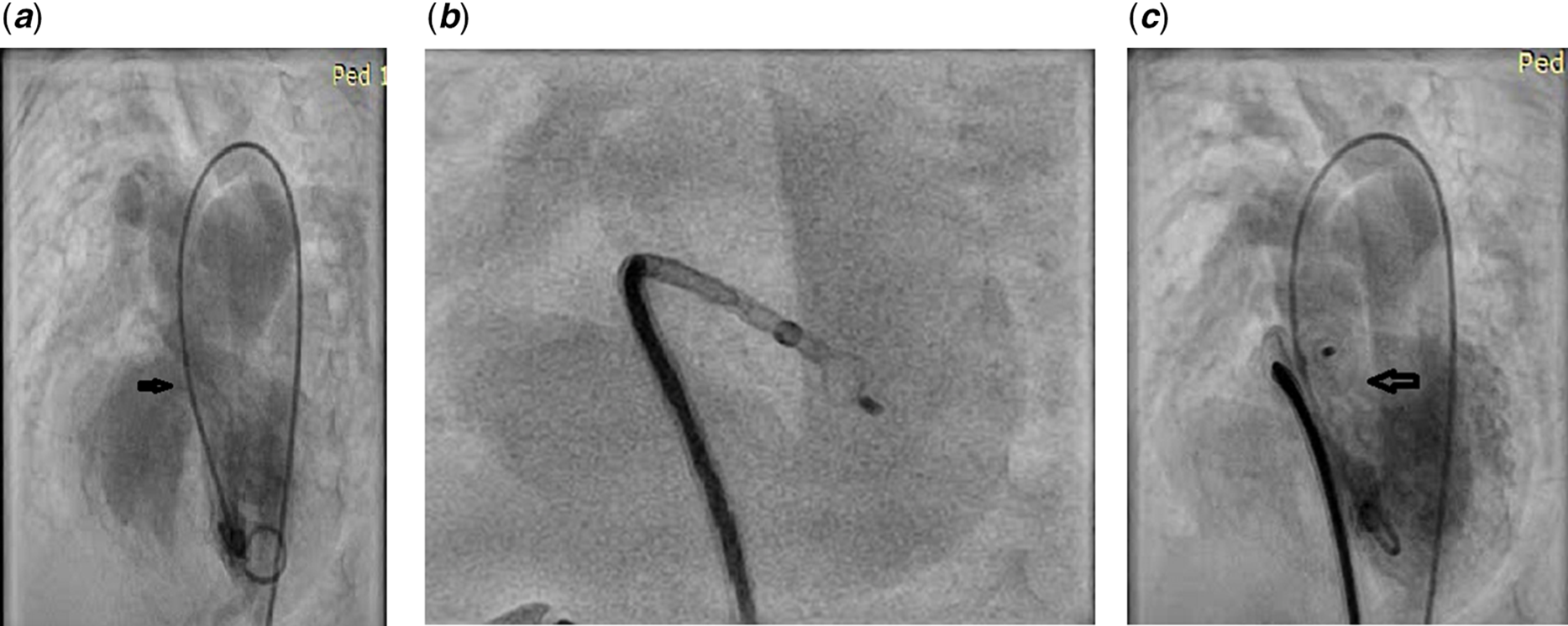 Transcatheter closure of ventricular septal defects in children less ...