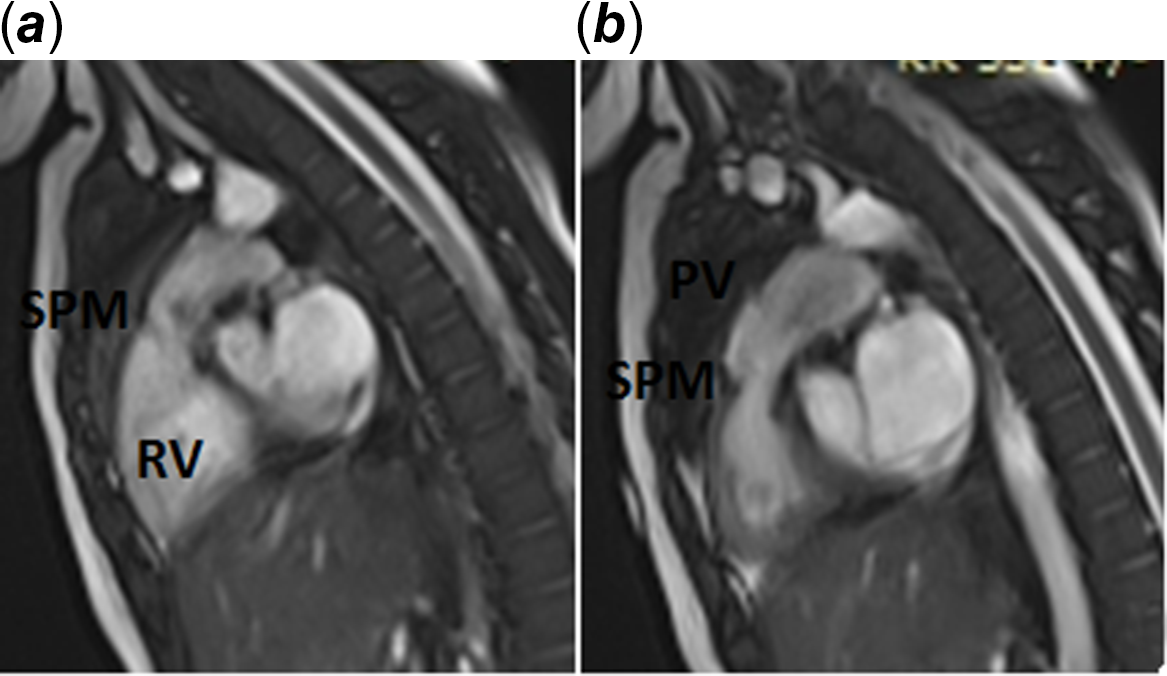 Rheology of right ventricular outflow tract obstruction: sub-pulmonary ...