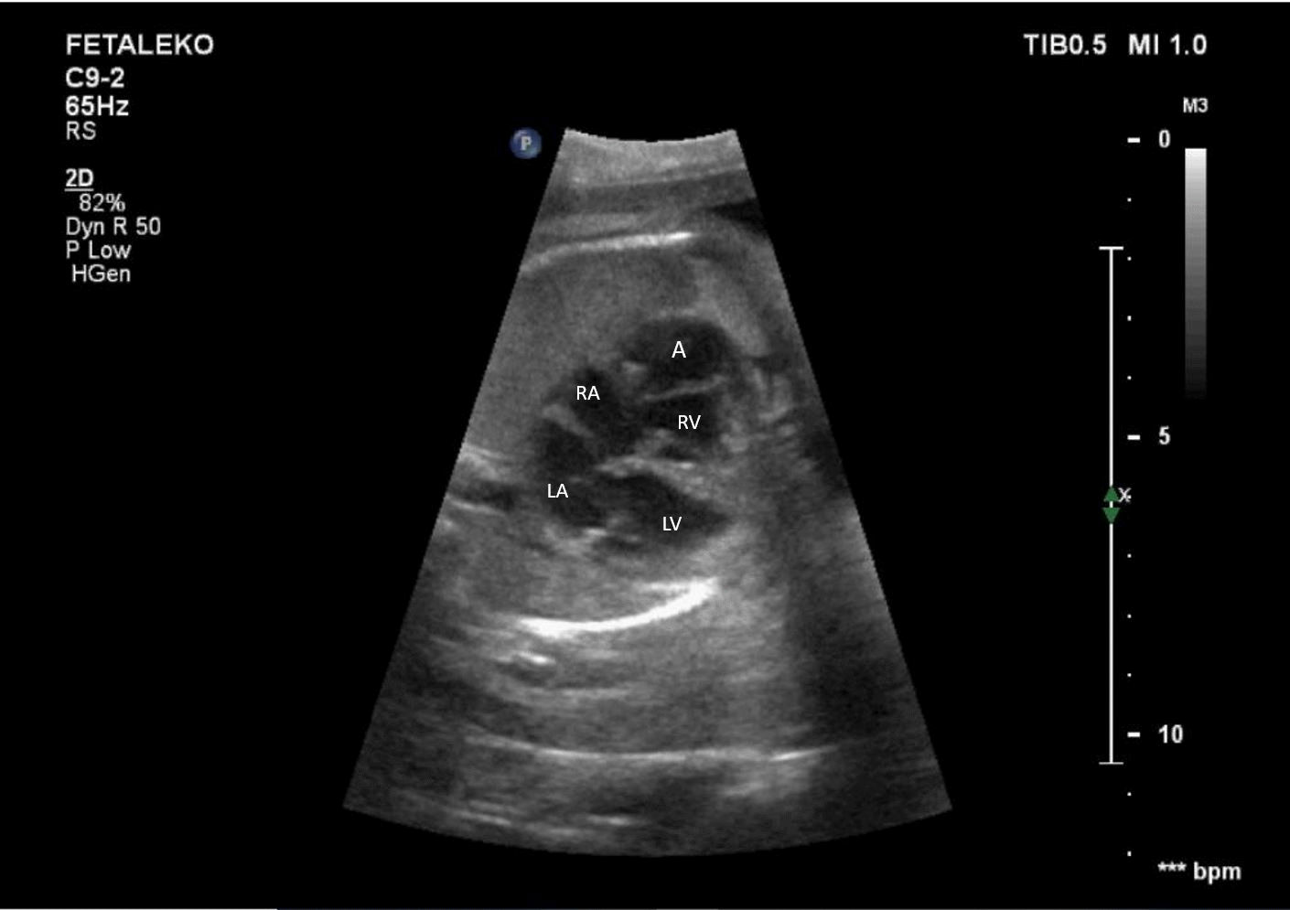 Prenatal diagnosis of a right ventricular outpouching: a report of case ...