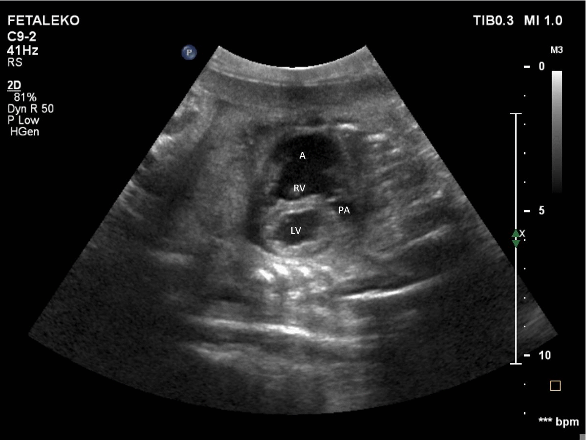 Prenatal diagnosis of a right ventricular outpouching: a report of case ...
