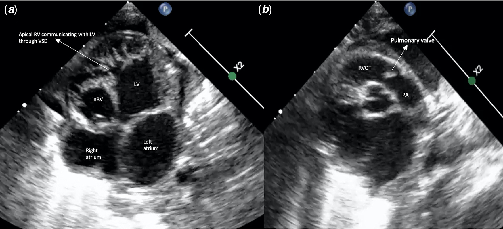 Double-chambered right ventricle masquerading as bipartite right ...