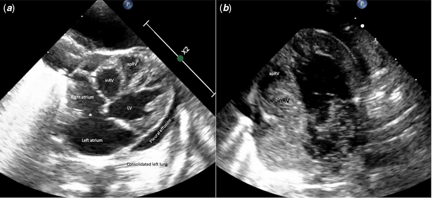Double-chambered right ventricle masquerading as bipartite right ...