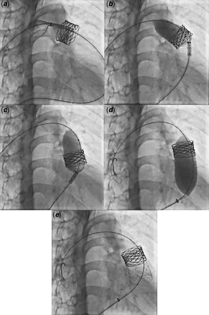 Repositioning an embolised stent during a percutaneous pulmonary valve ...